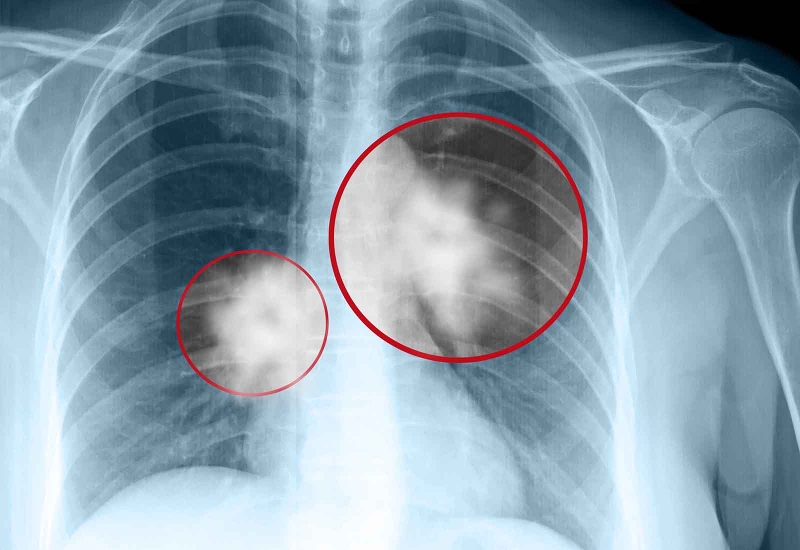 Respiratory, Lung Cancer and Sleep Research | Woolcock Institute of ...